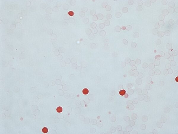 Red Blood Cell Isoimmunisation and Pregnancy - TeachMeObGyn