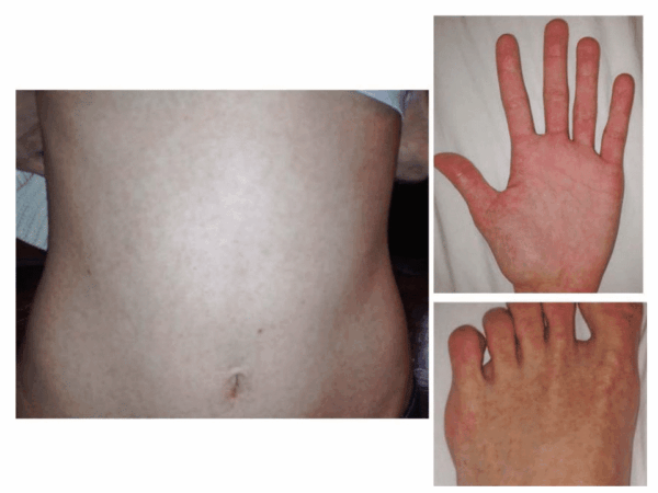 Antiphospholipid Syndrome - Clinical Features - Management - TeachMeObGyn