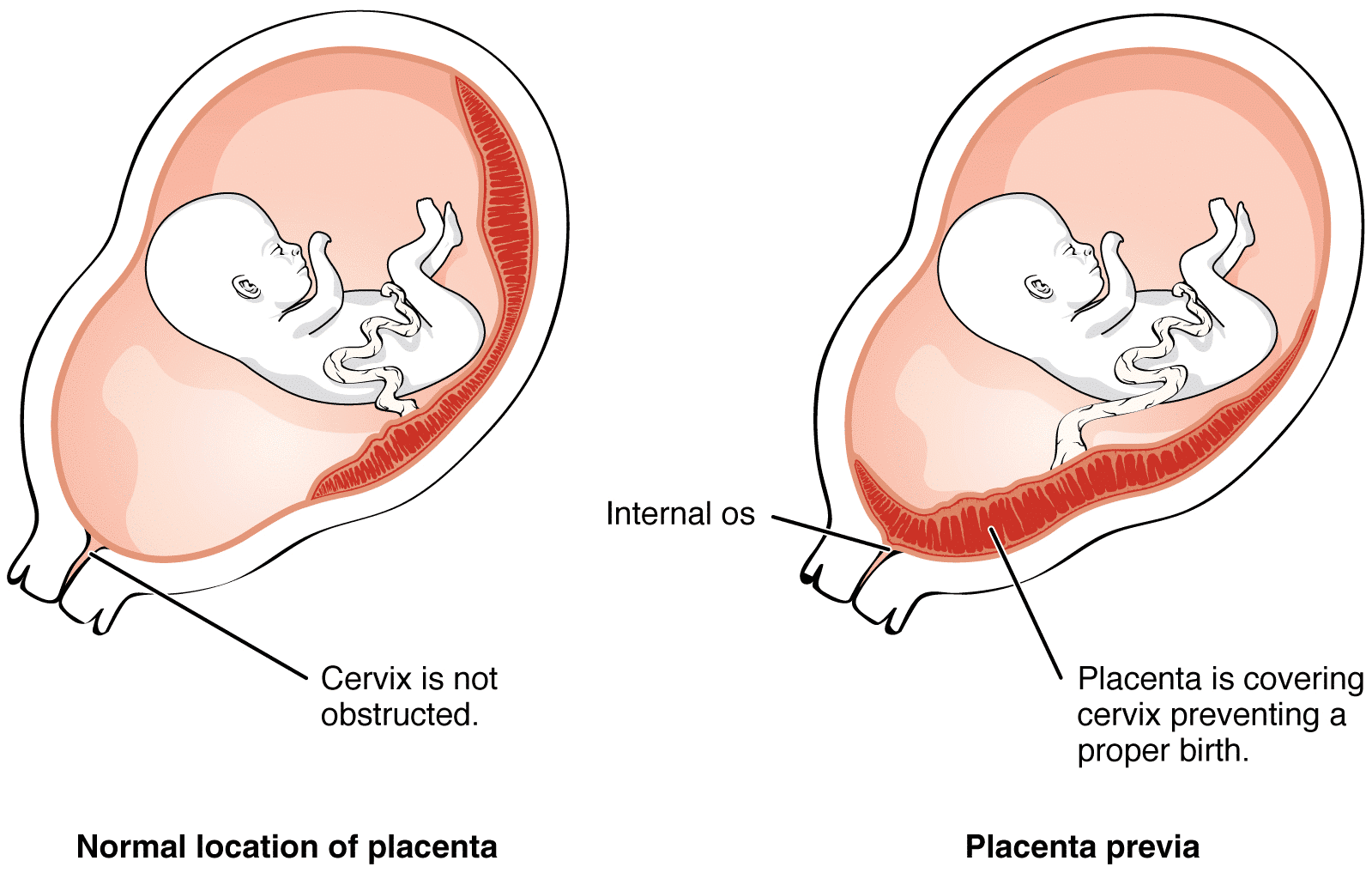 Placenta Praevia Causes Clinical Features Management TeachMeObGyn